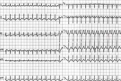 Chapitre 15 - Item 231 : Électrocardiogramme : indications et ...