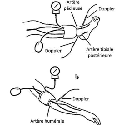Chapitre 07 - Item 225 : Artériopathie de l'aorte, des artères ...