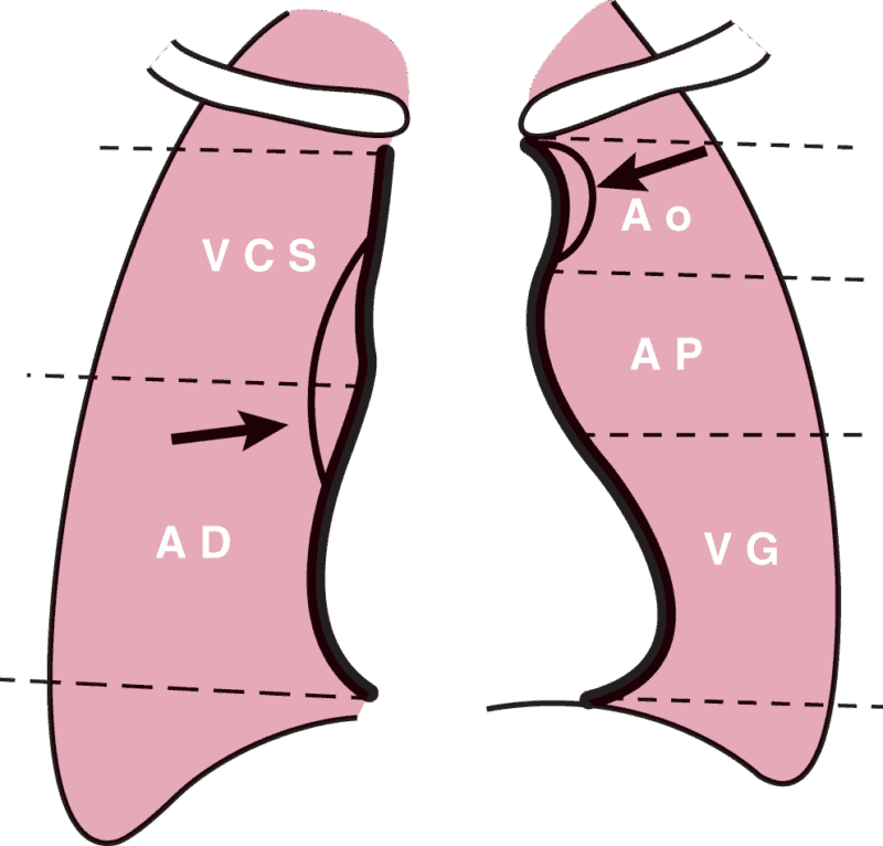 Chapitre 4 - Valvulopathies - SFCARDIO