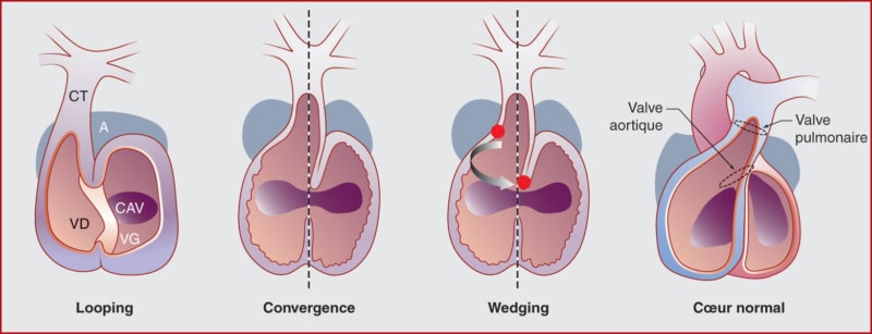 Chapitre 4 - Valvulopathies - SFCARDIO