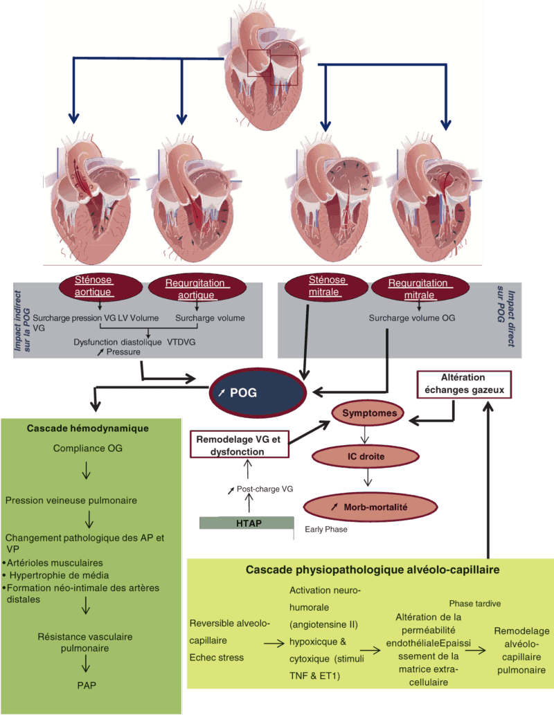 Chapitre 4 - Valvulopathies - SFCARDIO