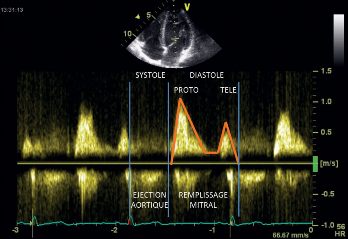 Chapitre 5 - Insuffisance cardiaque - SFCARDIO