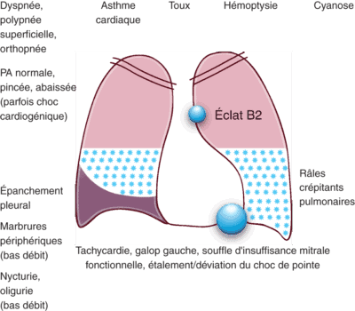 Chapitre 5 - Insuffisance cardiaque - SFCARDIO